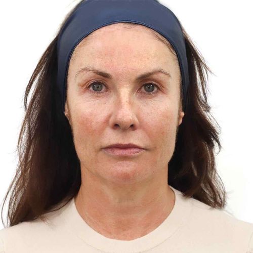 Aesthetic Treatment Results | Sisu Clinic