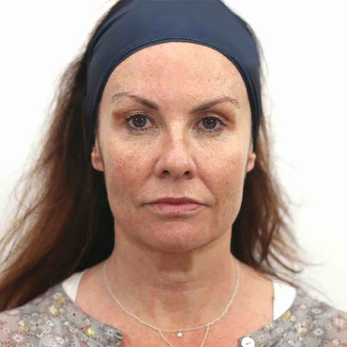 Aesthetic Treatment Results | Sisu Clinic