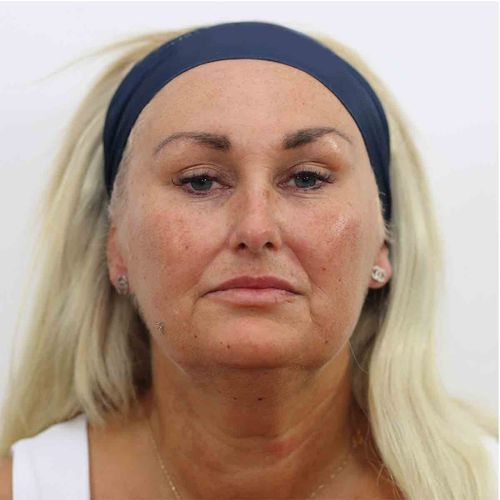 Aesthetic Treatment Results | Sisu Clinic