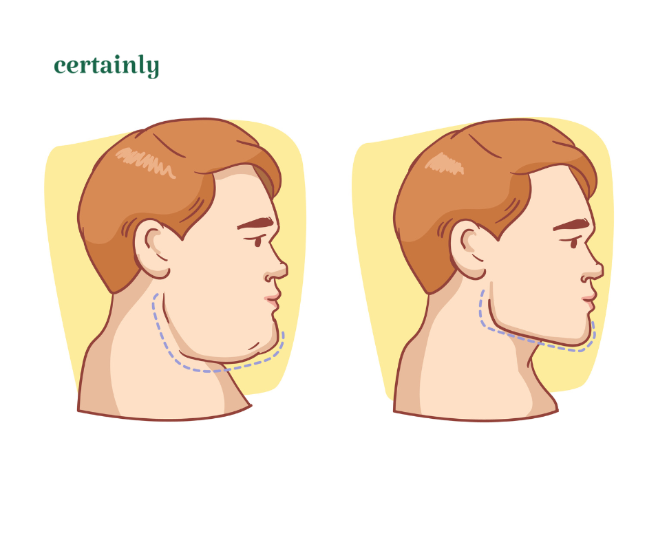 Benefits & Risks of Masseter Botox for TMJ Disorder | Certainly Health