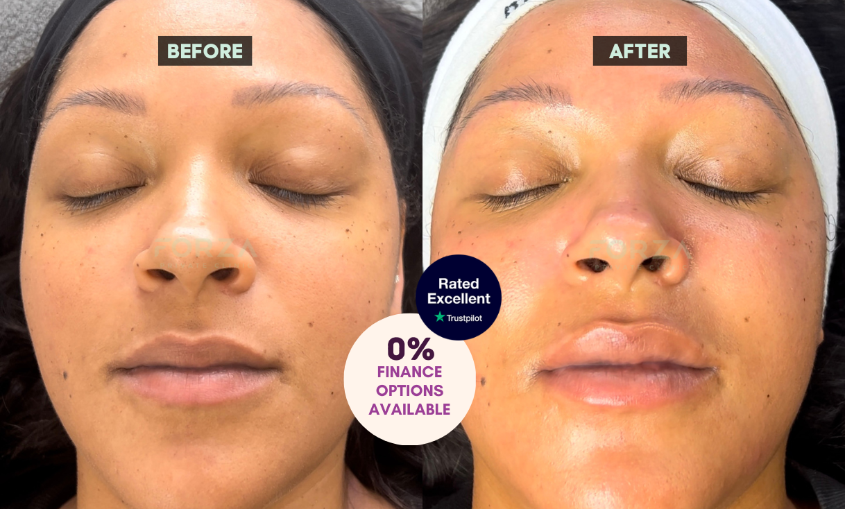 653be10c997b0f2bdc4d458b_Profhilo (2).png