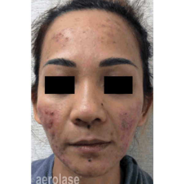 Experience Advanced Skin Care with Aerolase Neo