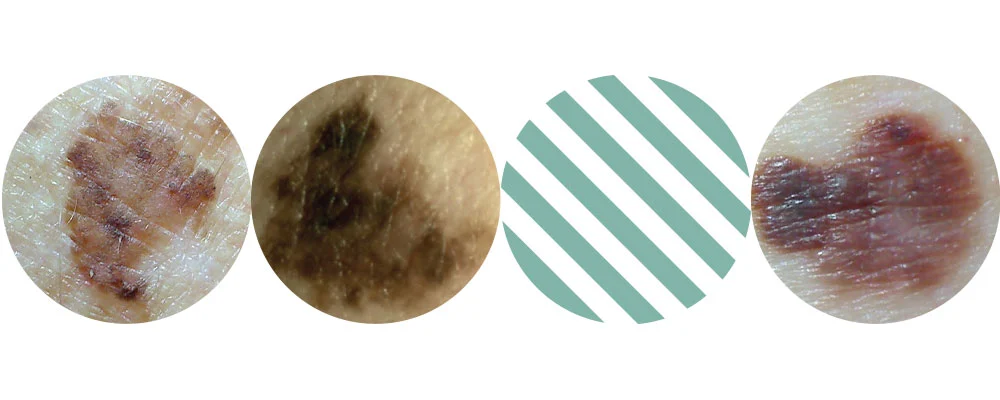 Signs of Skin Cancer: ABCDEFG Guidelines