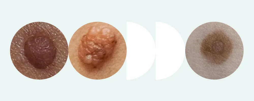 7 Melanoma Symptoms (Plus Images) to Watch For