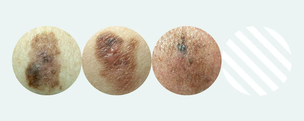 7 Melanoma Symptoms (Plus Images) to Watch For