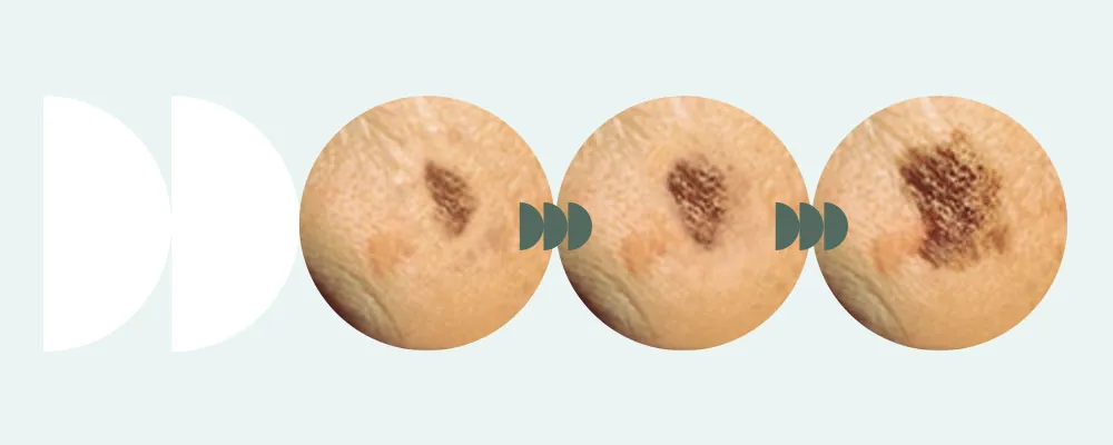 7 Melanoma Symptoms (Plus Images) to Watch For
