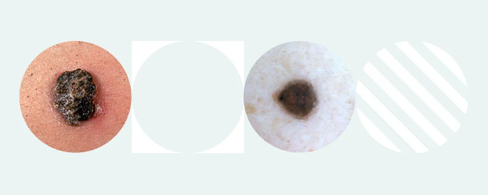 Nodular Melanoma: Images, Symptoms & Survival Rates