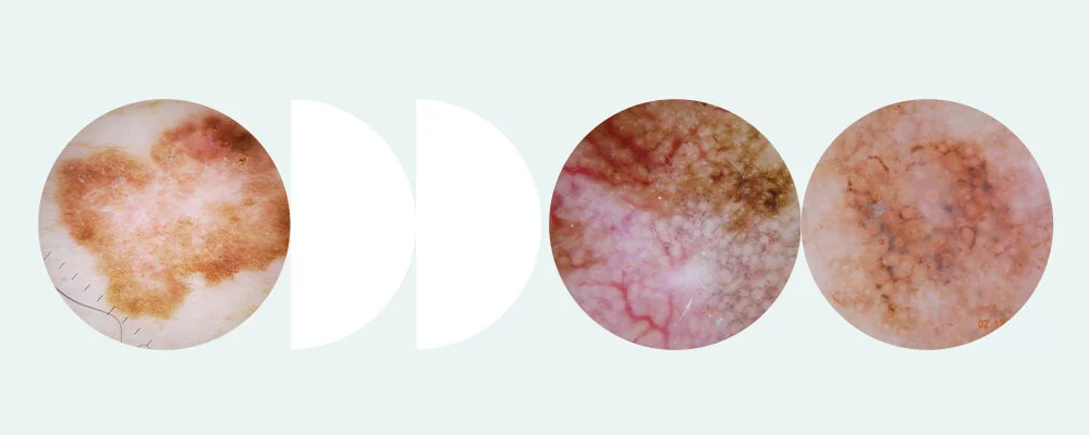 Superficial Spreading Melanoma - Symptoms & Treatment