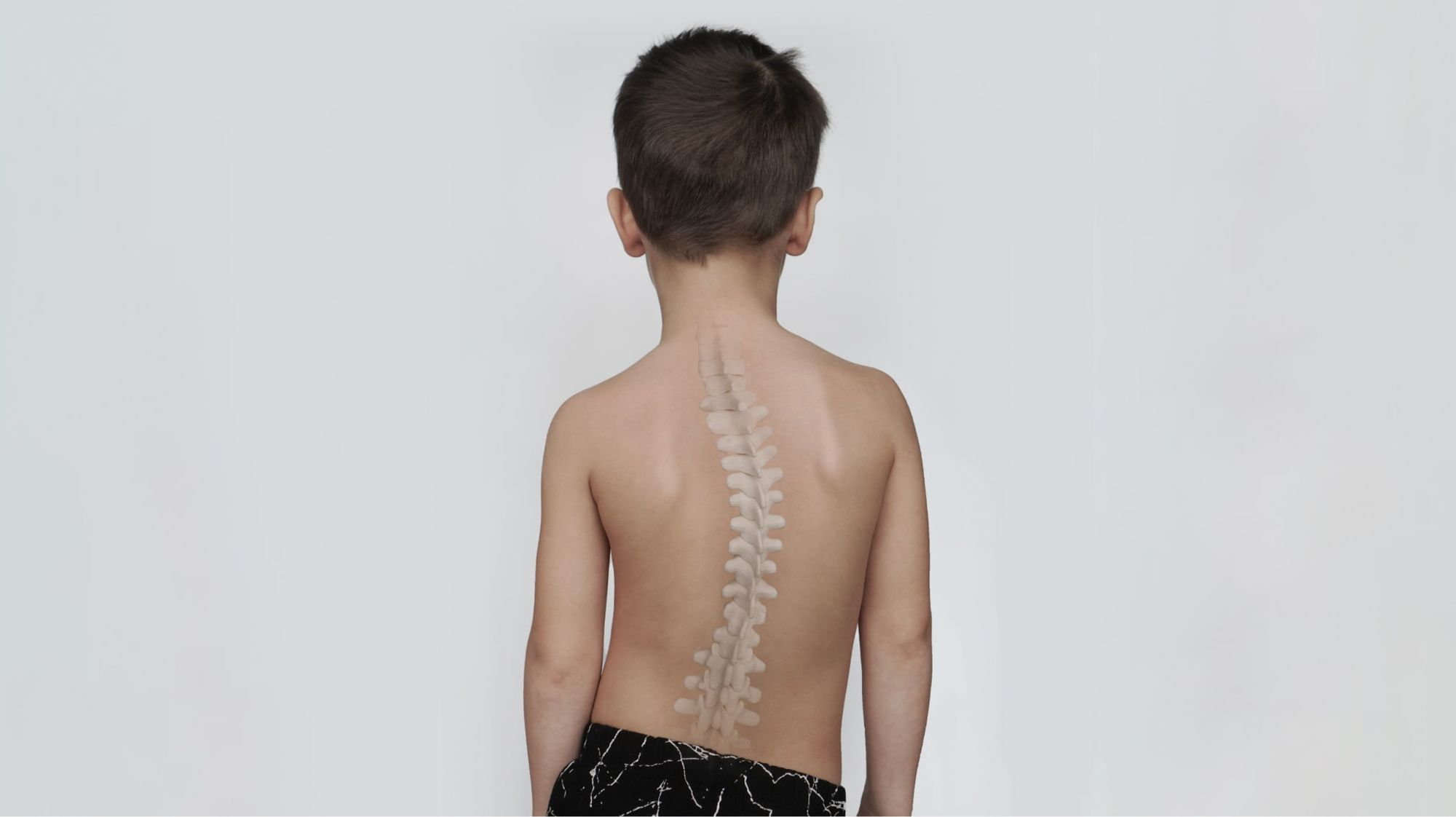 Paediatric Scoliosis | Spine Care