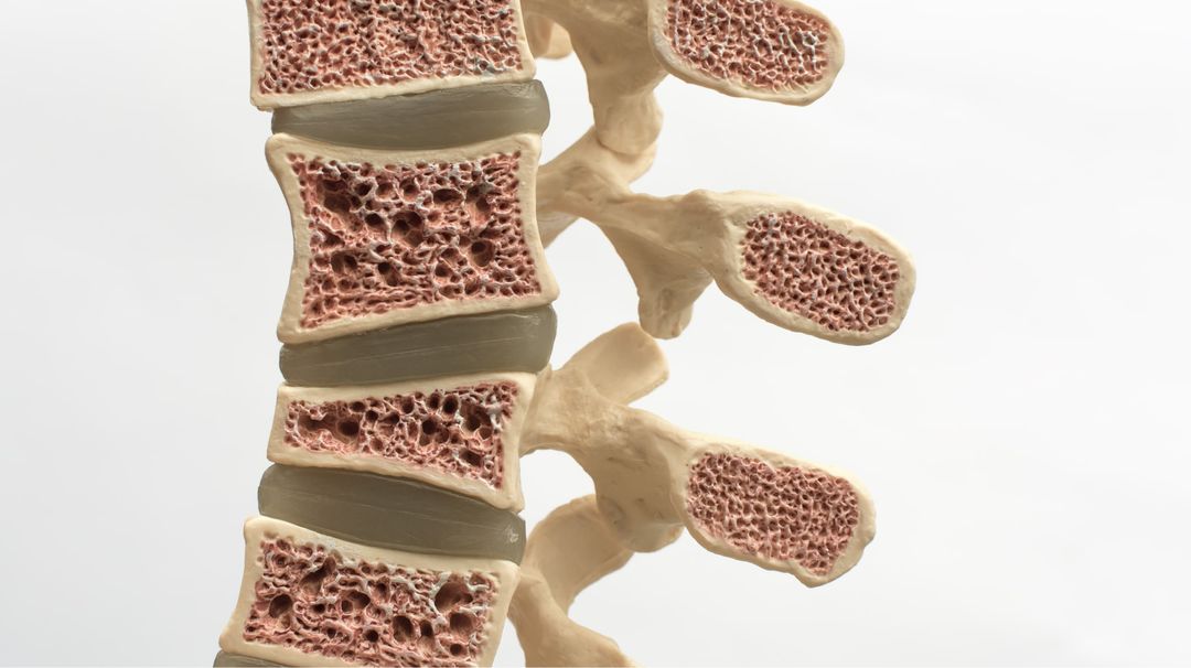 Osteoporotic Fractures | Spine Care