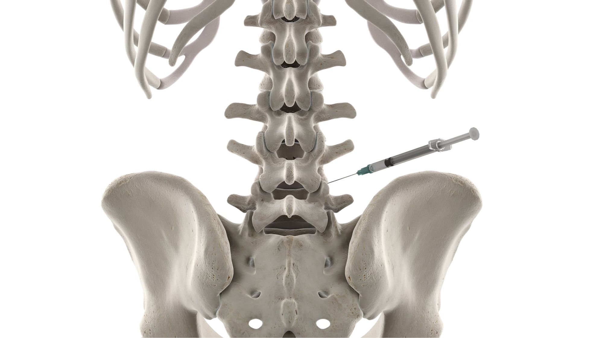 Facet Joint Injections or Medial Bundle Branch Block | Spine Care