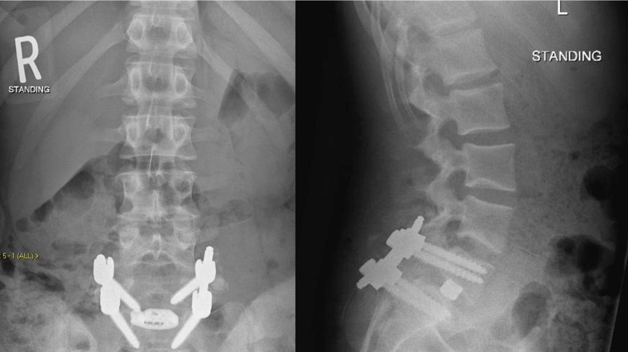 TLIF | Spine Care