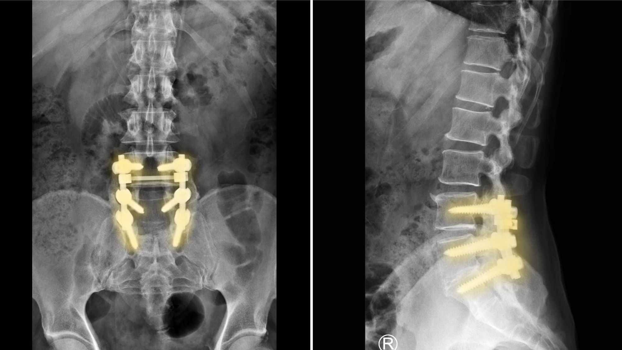 Posterolateral Fusion | Spine Care
