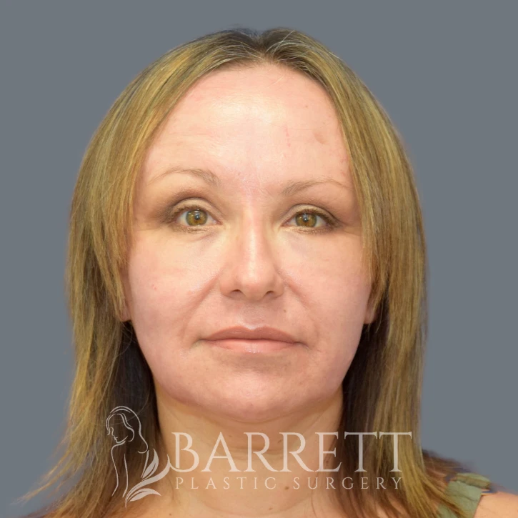 Lip Enhancement Beverly Hills | Barrett Plastic Surgery