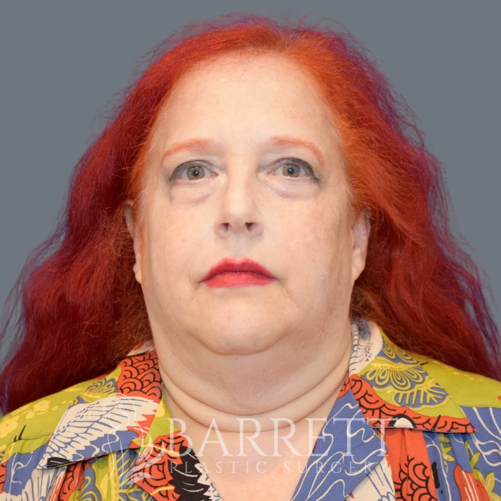 Eyelid Surgery Before And After Photos