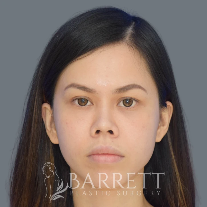 Lip Enhancement Beverly Hills | Barrett Plastic Surgery