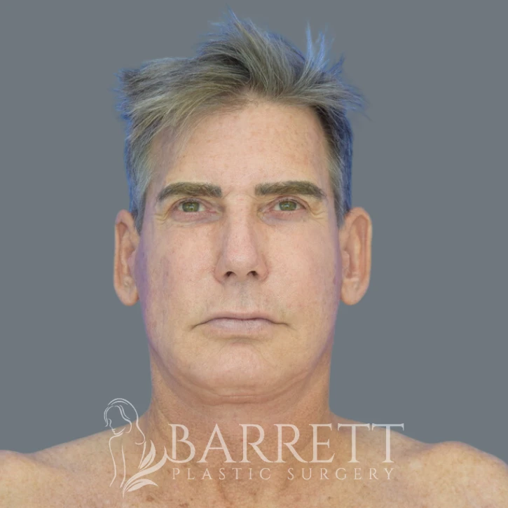 Lip Enhancement Beverly Hills | Barrett Plastic Surgery