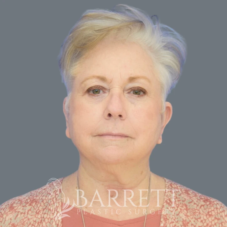 Lip Enhancement Beverly Hills | Barrett Plastic Surgery