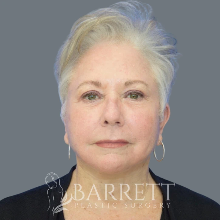 Lip Enhancement Beverly Hills | Barrett Plastic Surgery
