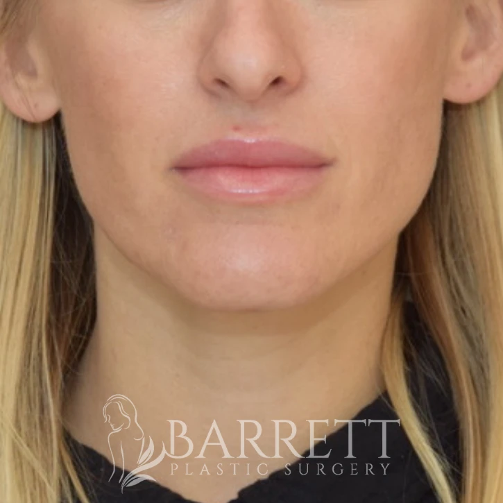 Lip Enhancement Beverly Hills | Barrett Plastic Surgery