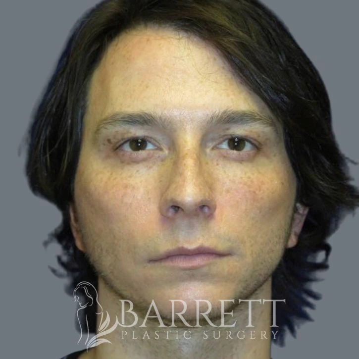 Rhinoplasty Beverly Hills | Barrett Plastic Surgery