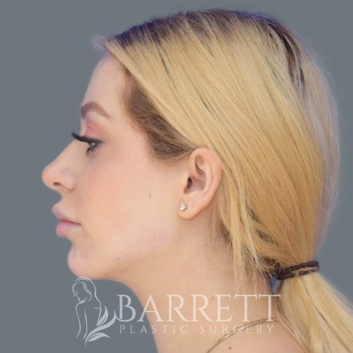 Rhinoplasty Beverly Hills | Barrett Plastic Surgery