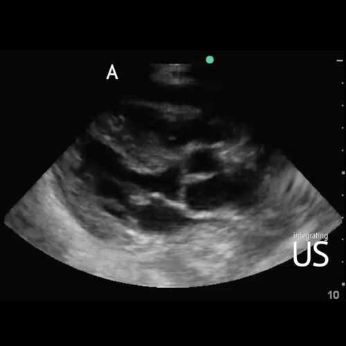 Cardiac Masses, Thrombi, & Vegetations