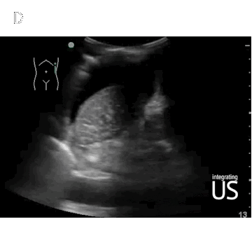 Abdominal Free Fluid, LIver Disease, & Bowel Distension