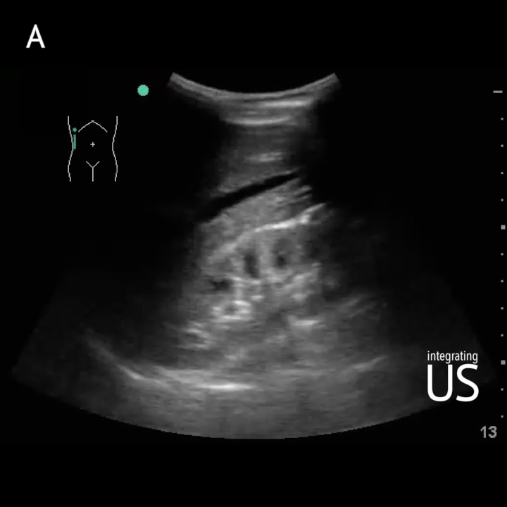 Abdominal Free Fluid, LIver Disease, & Bowel Distension