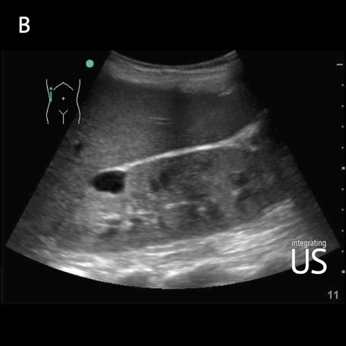Abdominal Free Fluid, LIver Disease, & Bowel Distension