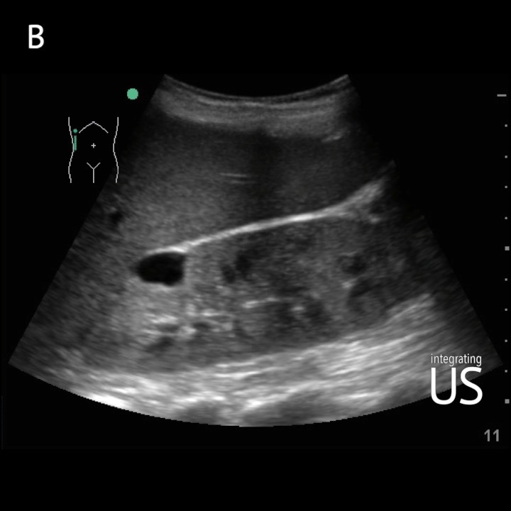 Abdominal Free Fluid, LIver Disease, & Bowel Distension