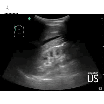 Abdominal Free Fluid, LIver Disease, & Bowel Distension