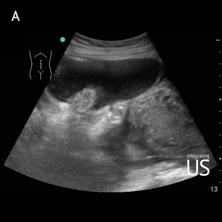 Abdominal Free Fluid, LIver Disease, & Bowel Distension