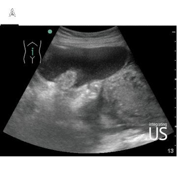 Abdominal Free Fluid, LIver Disease, & Bowel Distension