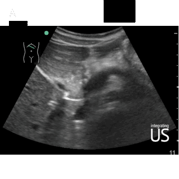 Abdominal Free Fluid, LIver Disease, & Bowel Distension