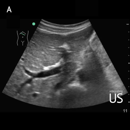 Abdominal Free Fluid, LIver Disease, & Bowel Distension