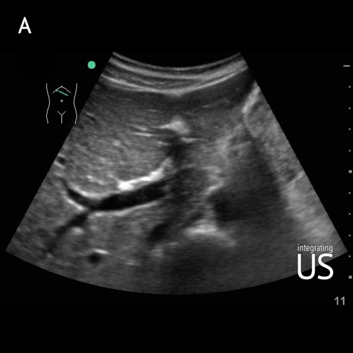 Abdominal Free Fluid, LIver Disease, & Bowel Distension