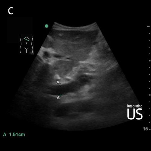 Abdominal Free Fluid, LIver Disease, & Bowel Distension