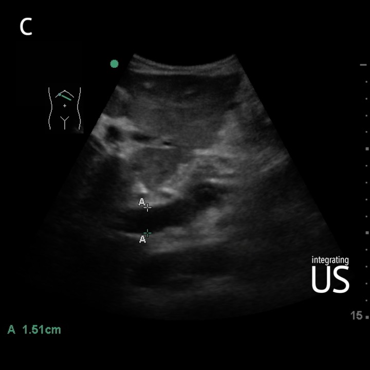 Abdominal Free Fluid, LIver Disease, & Bowel Distension
