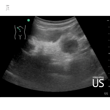 Abdominal Free Fluid, LIver Disease, & Bowel Distension