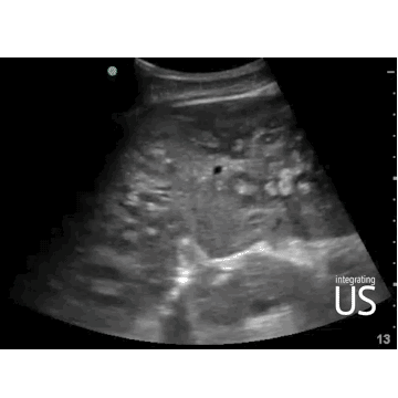 Abdominal Free Fluid, LIver Disease, & Bowel Distension
