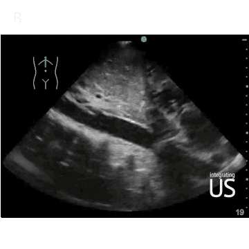 Fluid Intolerance & Sepsis