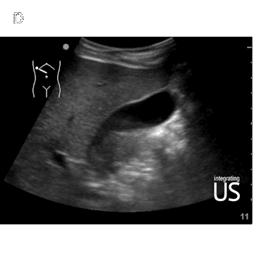 Abdominal Free Fluid, LIver Disease, & Bowel Distension