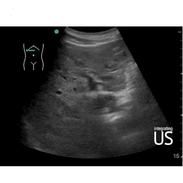 Abdominal Free Fluid, LIver Disease, & Bowel Distension