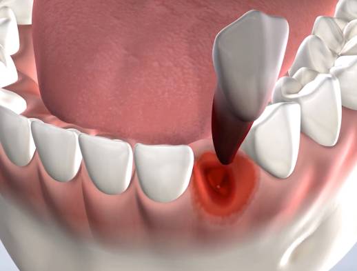 General Tooth Extraction at Oral Surgery Hawaii