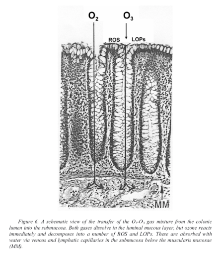 Rectal Ozone Therapy What It Is, How It Works and How to Do It Yourself