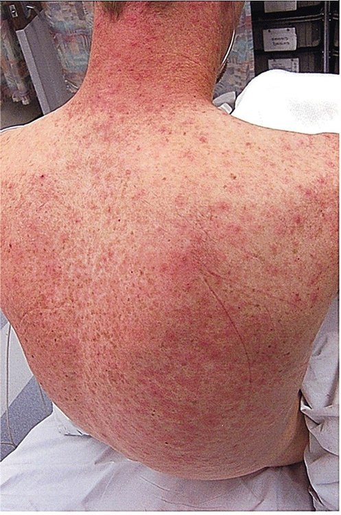 Rectal Ozone Therapy What It Is, How It Works and How to Do It Yourself