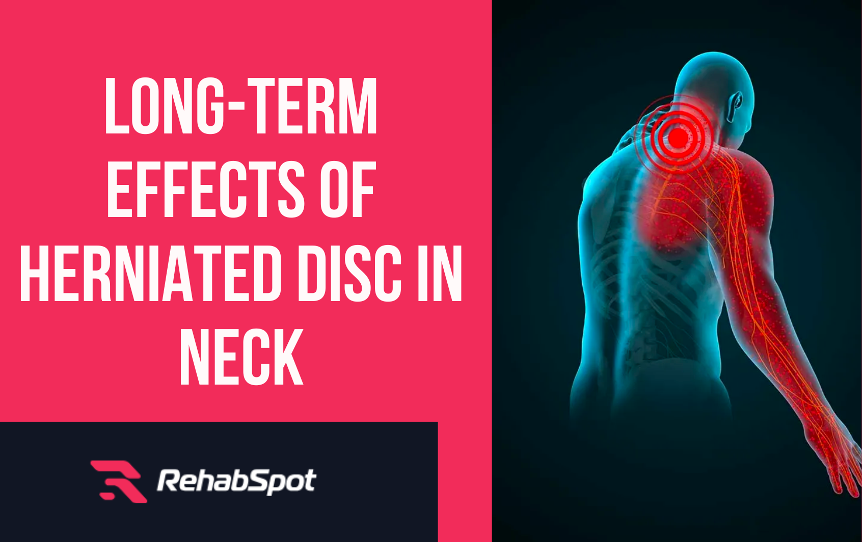 Long-Term Effects of Herniated Disc in the Neck
