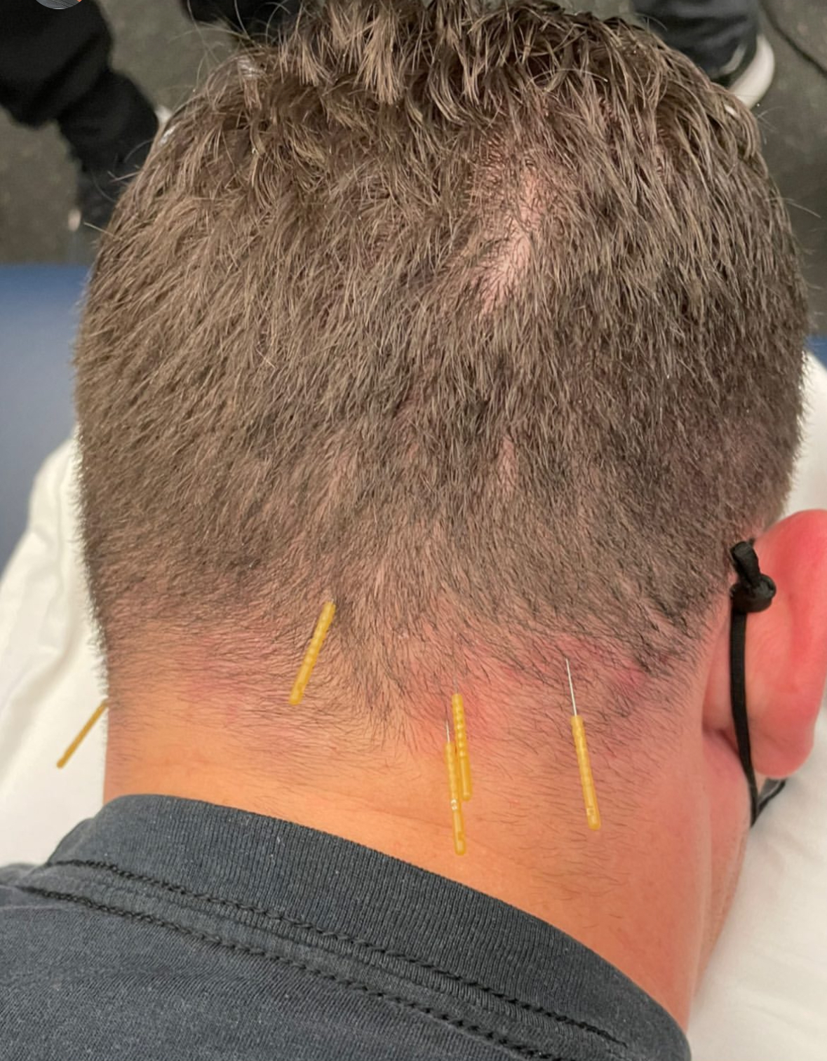 Long-Term Effects of Herniated Disc in the Neck