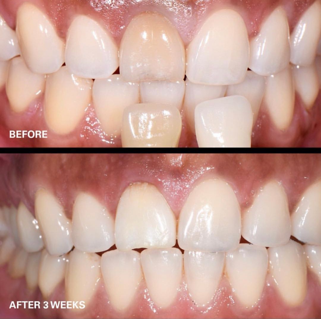 Endodontic Root Canals in Paoli | Precision Endodontic Network
